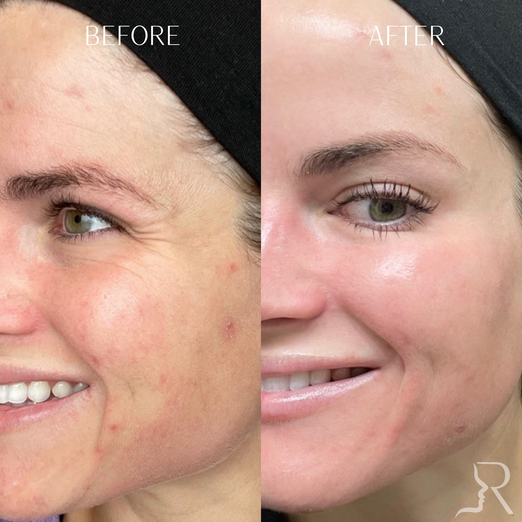 GloTox: The Ultimate Skin Glow-Up with a Peel and Tox Combo