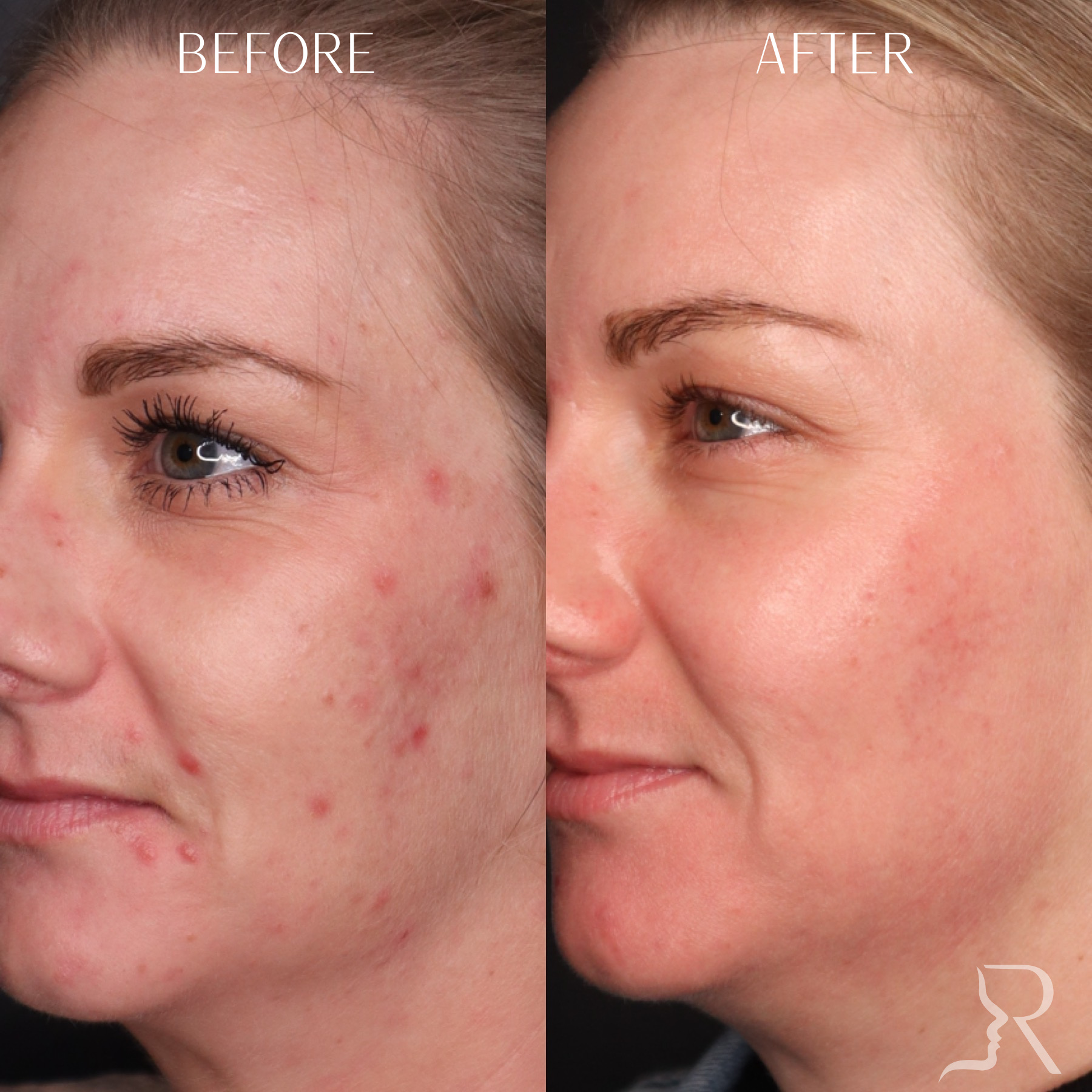 Laser Scar Revision: Smooth, Clear Skin is Within Reach