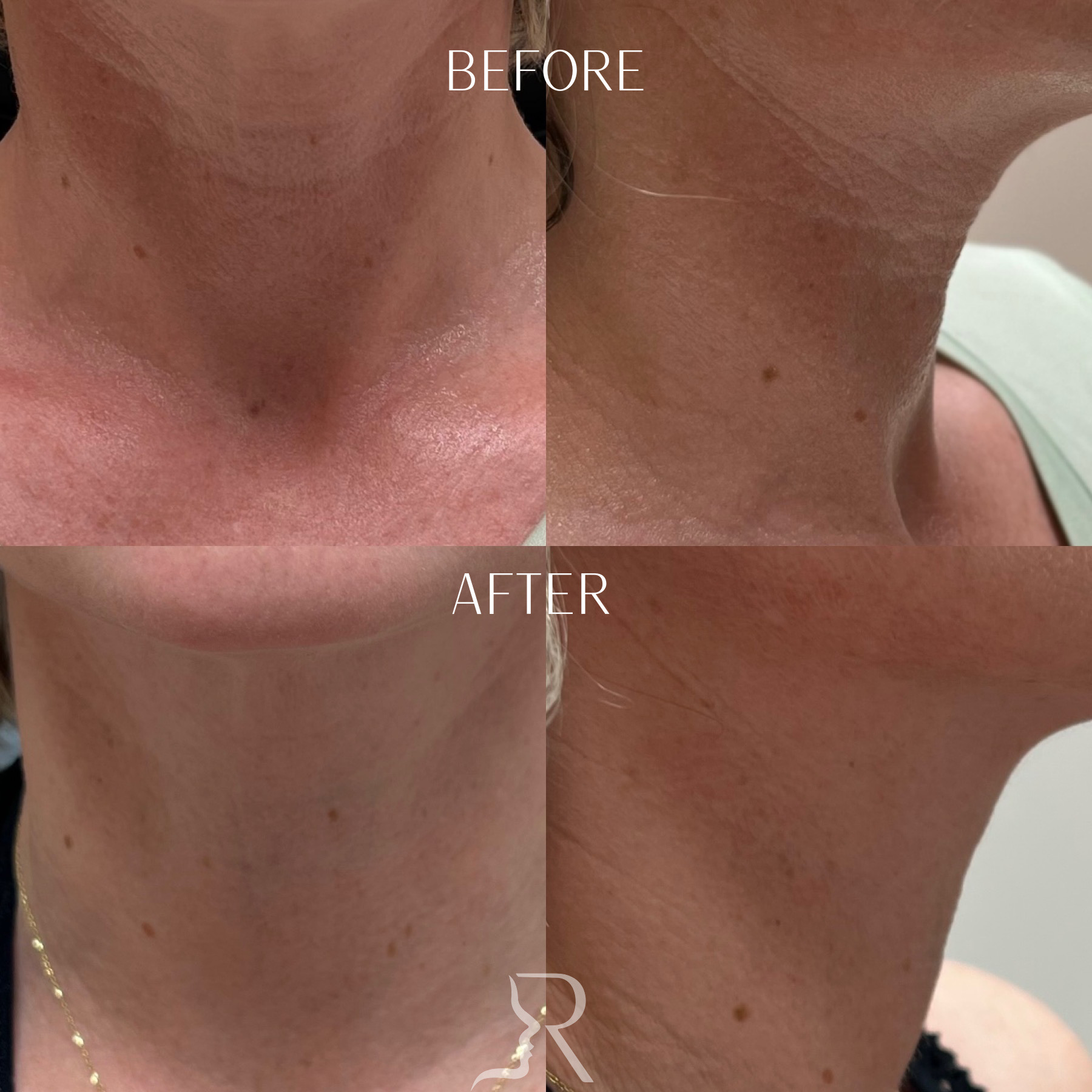 5 Minute Neck Lift: A Quick, Effective Solution for a Youthful Neck