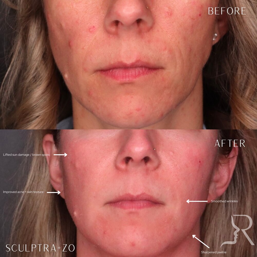 Sculptra: Natural, Long-Lasting Volume for a Youthful Look