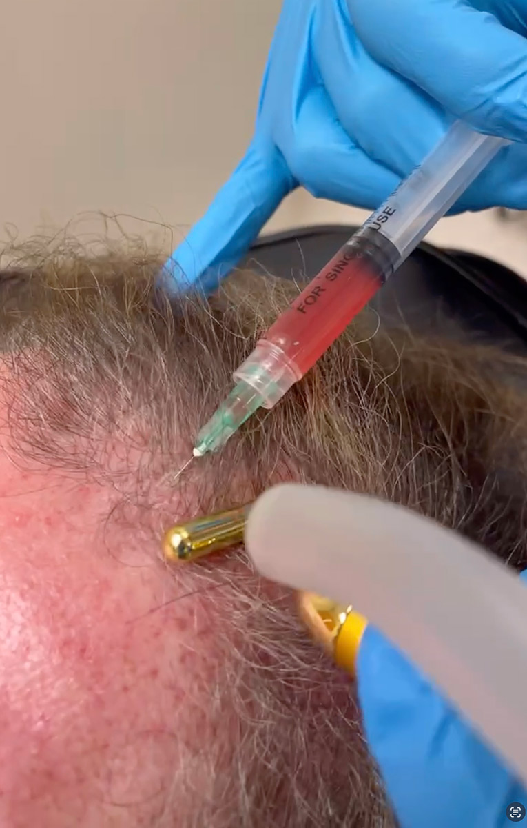 Hair Restoration Houma, LA | PRF & PDGF Injections